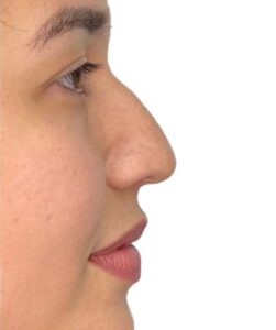 Non-Surgical Nose Job near me Orlando | Non-Surgical rhinoplasty